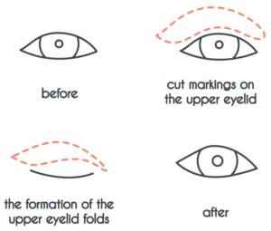 Blepharoplasty Bristol | Eyelid Surgery Johnson City | Regional Eye